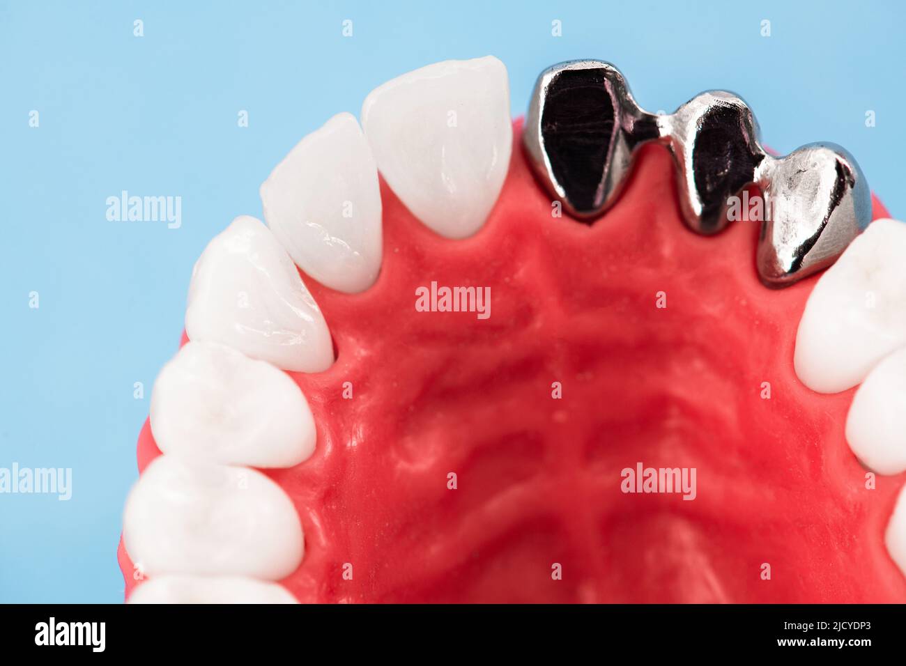 Teeth implant and crown installation process parts isolated on a blue ...