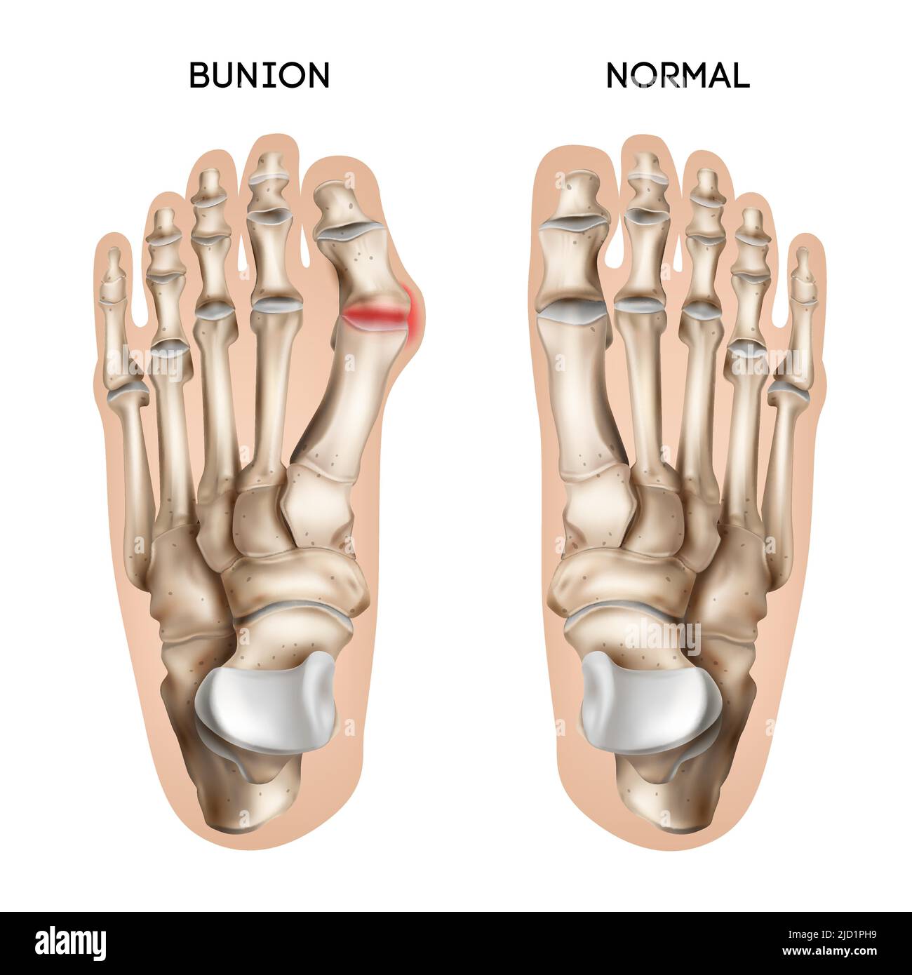 Realistic bunion foot composition with editable text captions and views ...