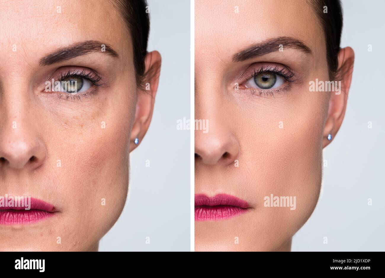 Photo Of Anti-aging Procedures On Caucasian Woman Face Stock Photo - Alamy