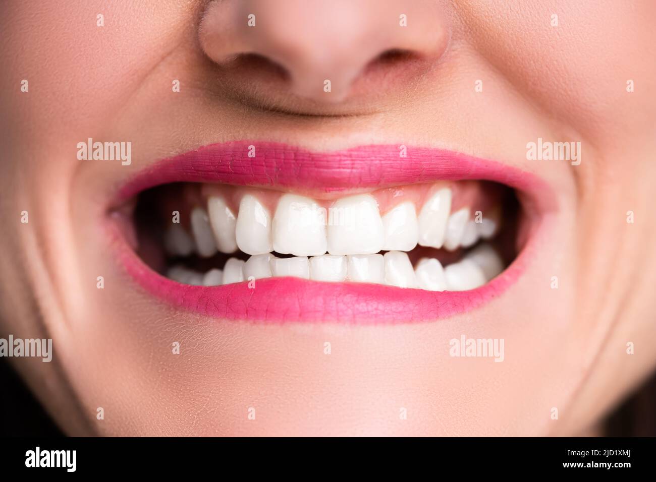 Patient White Teeth Smile Closeup After Whitening Stock Photo - Alamy