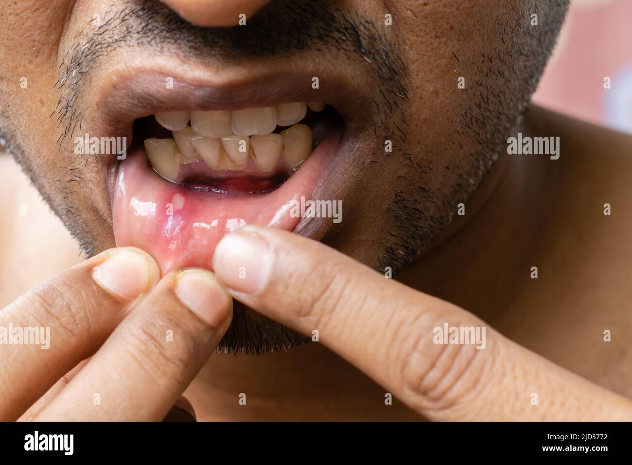 Mouth ulcer hi-res stock photography and images - Alamy