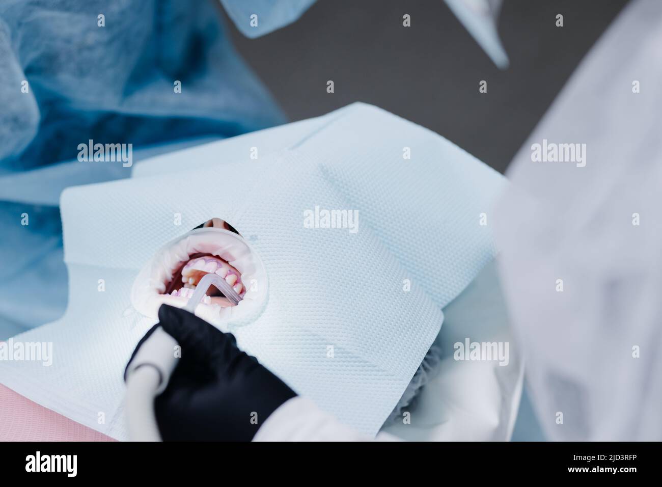 The process of cleansing the mouth of saliva. Dental procedures. High ...