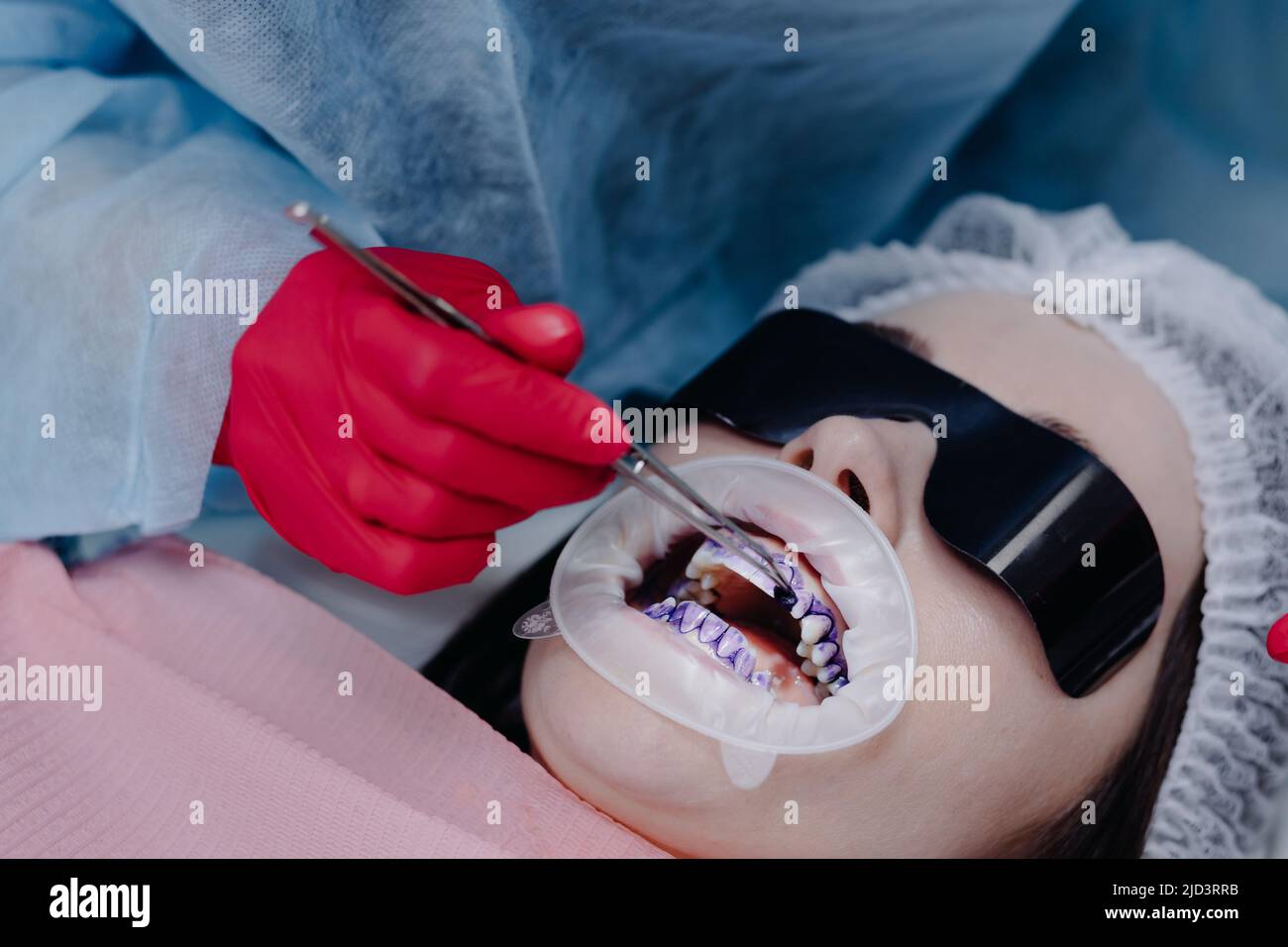 A female dentist with dental instruments applies a purple solution to ...