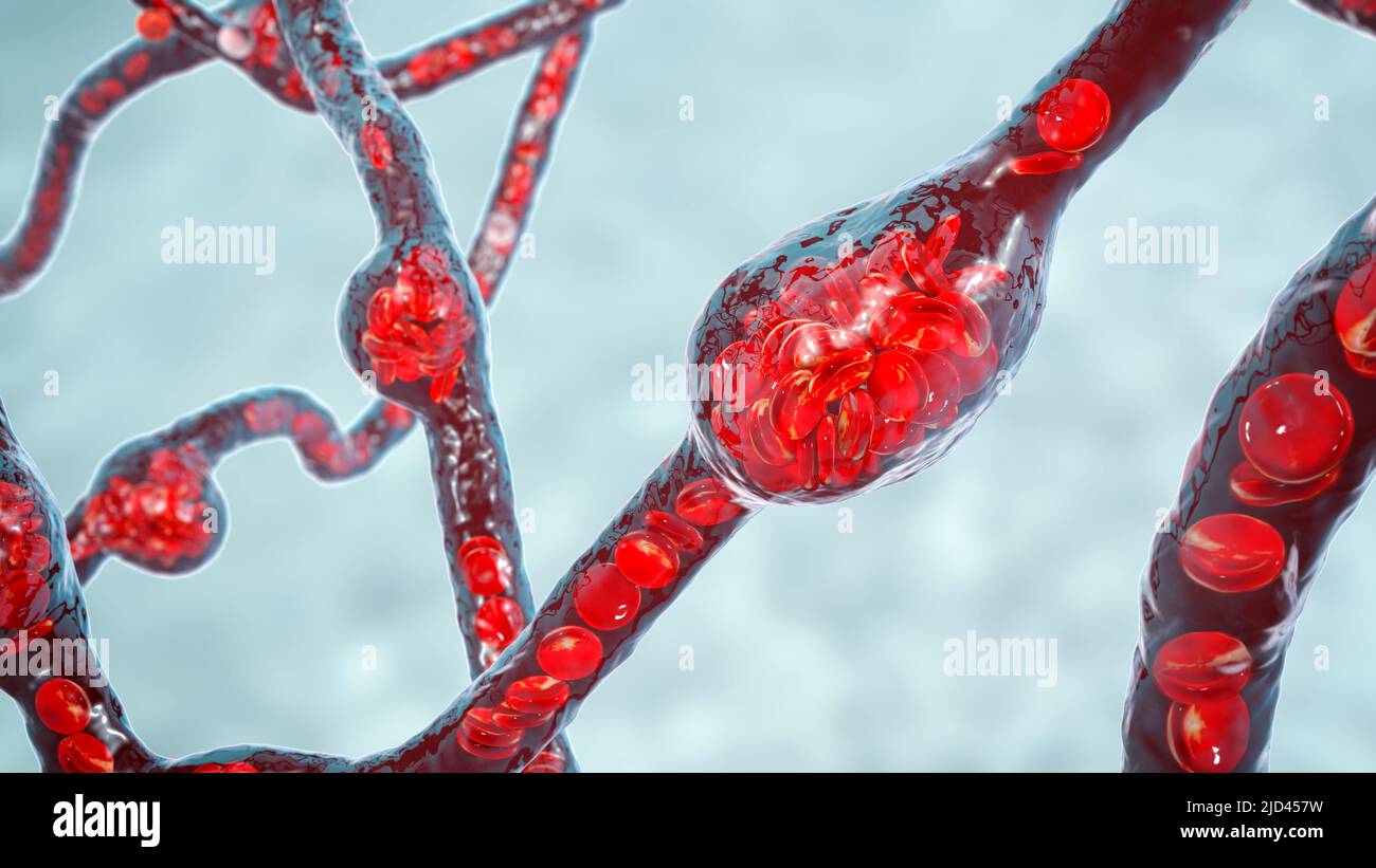 Charcot bouchard hi-res stock photography and images - Alamy