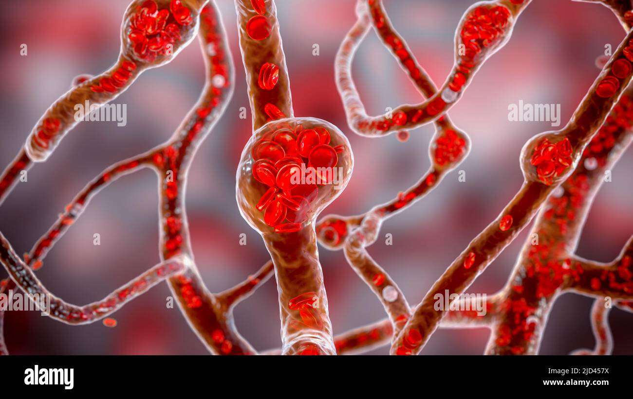 Charcot bouchard hi-res stock photography and images - Alamy