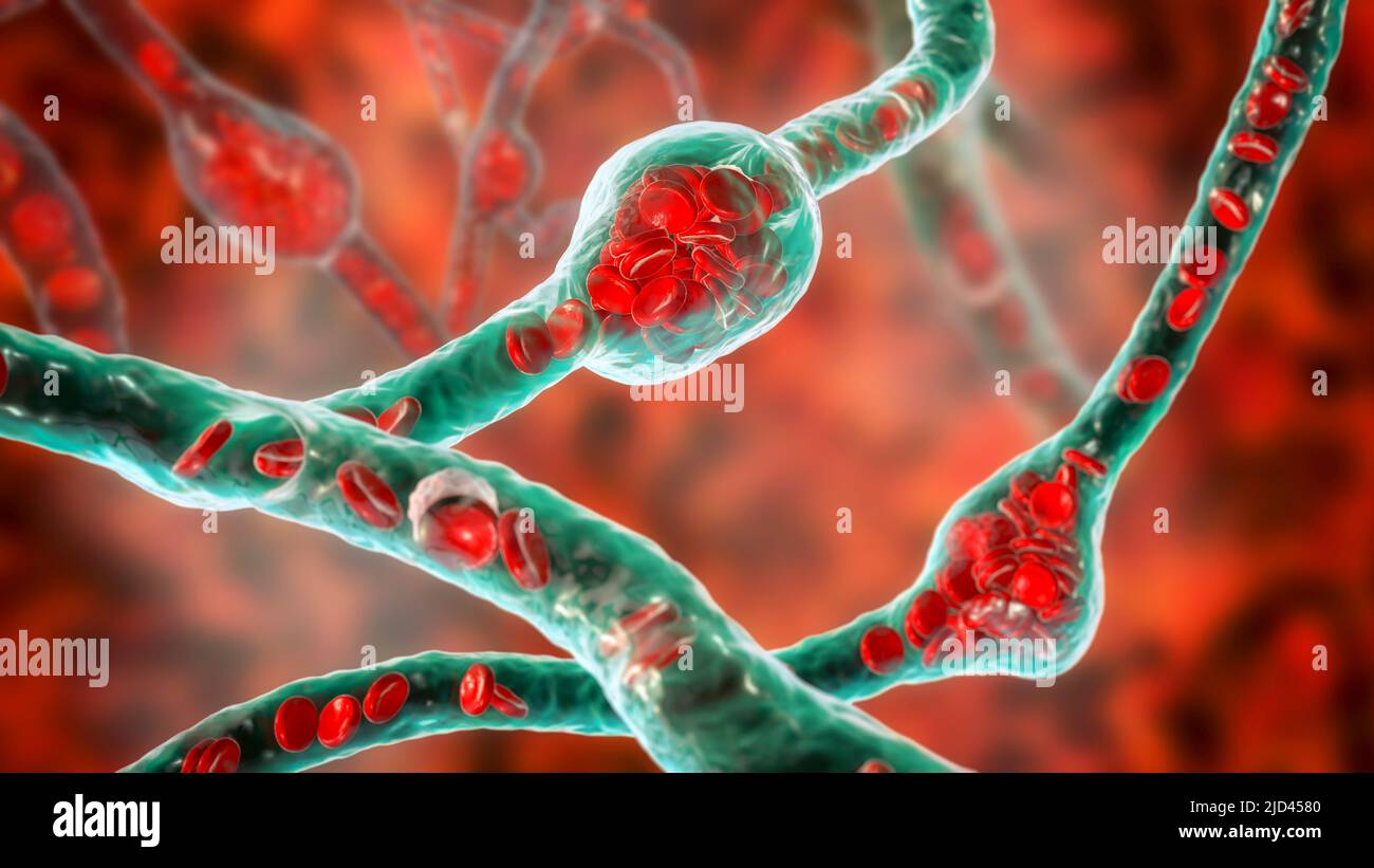 Charcot bouchard hi-res stock photography and images - Alamy