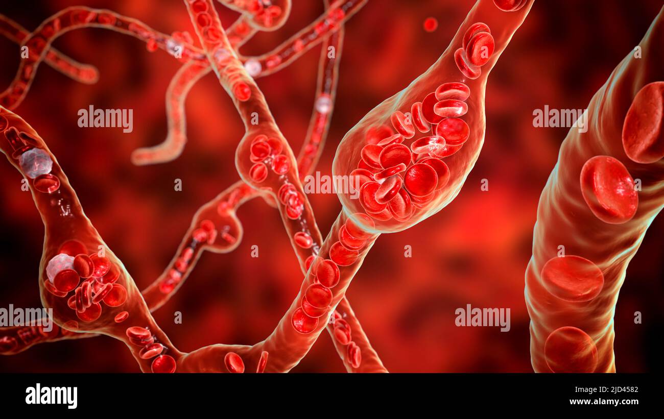 Charcot bouchard hi-res stock photography and images - Alamy