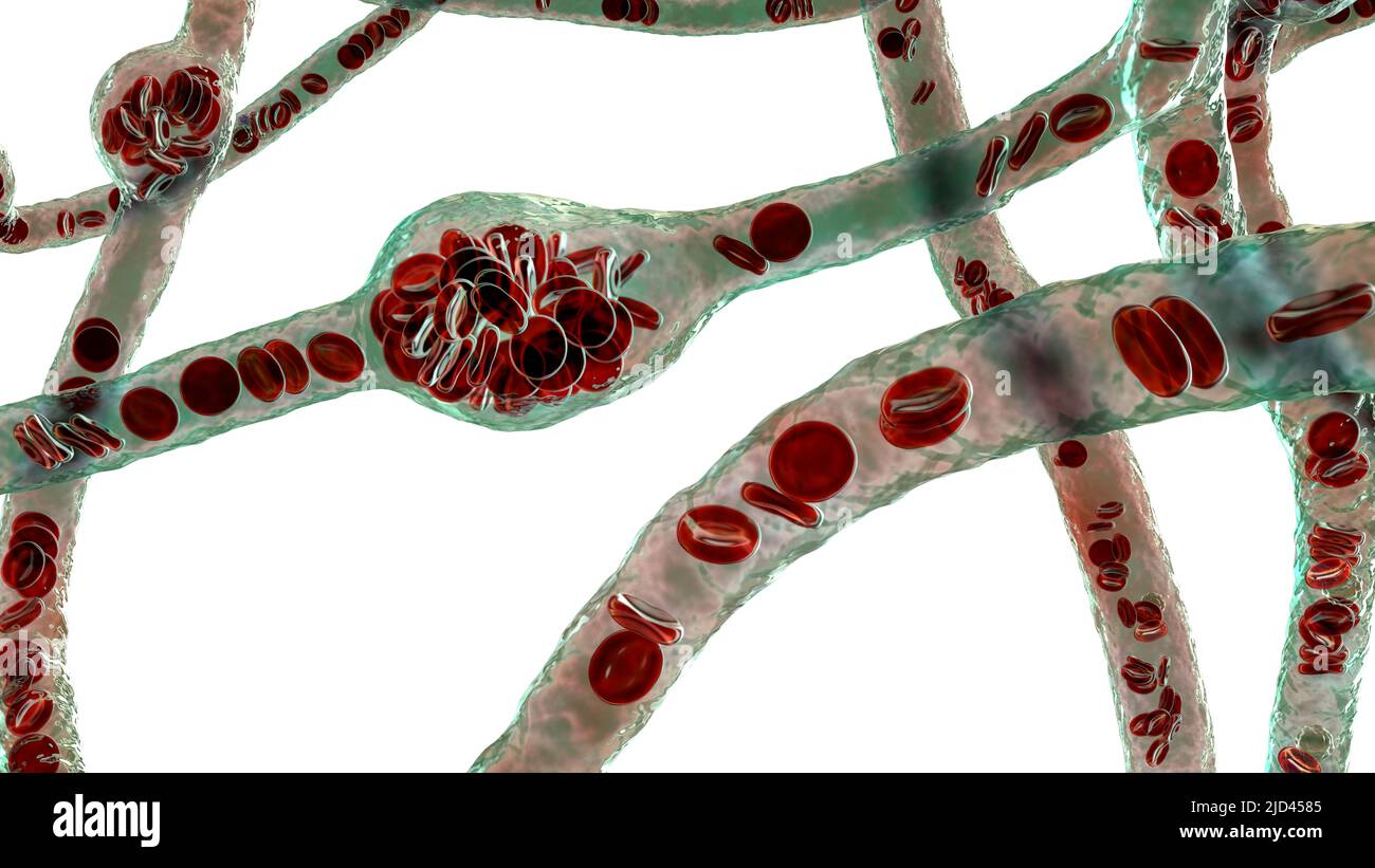 Microaneurisma De Charcot Bouchard - RETOEDU