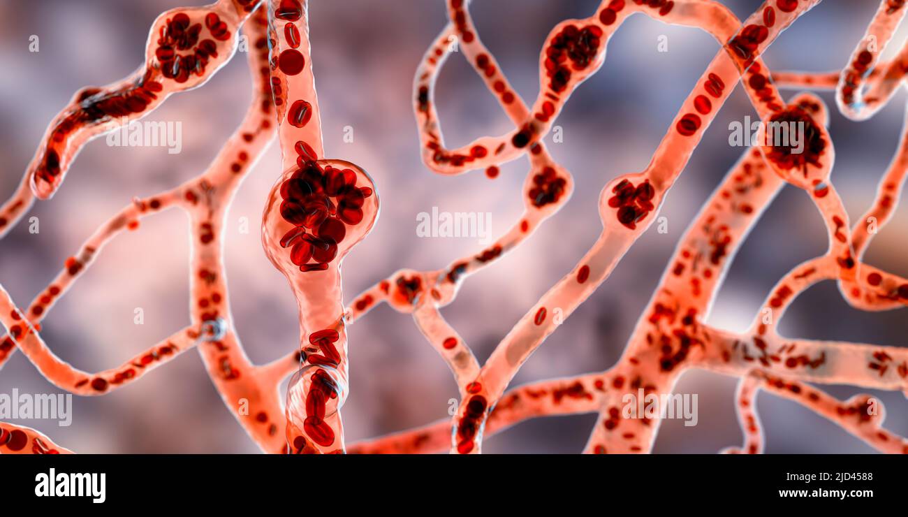 Charcot bouchard hi-res stock photography and images - Alamy