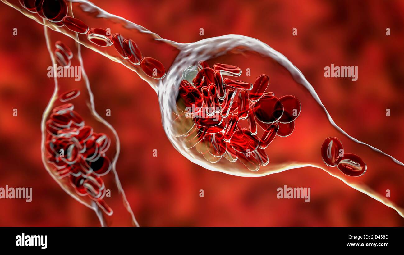 Charcot bouchard hi-res stock photography and images - Alamy