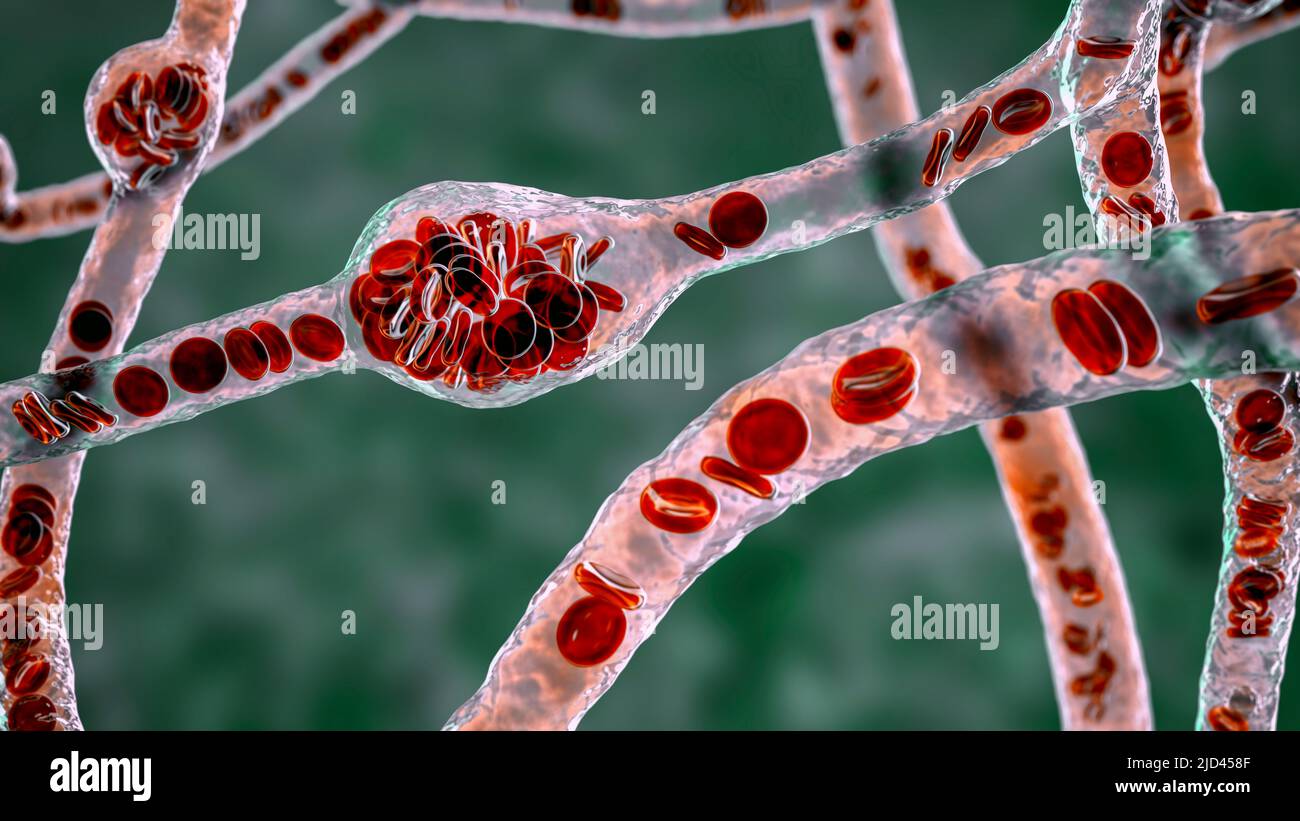 Charcot bouchard hi-res stock photography and images - Alamy