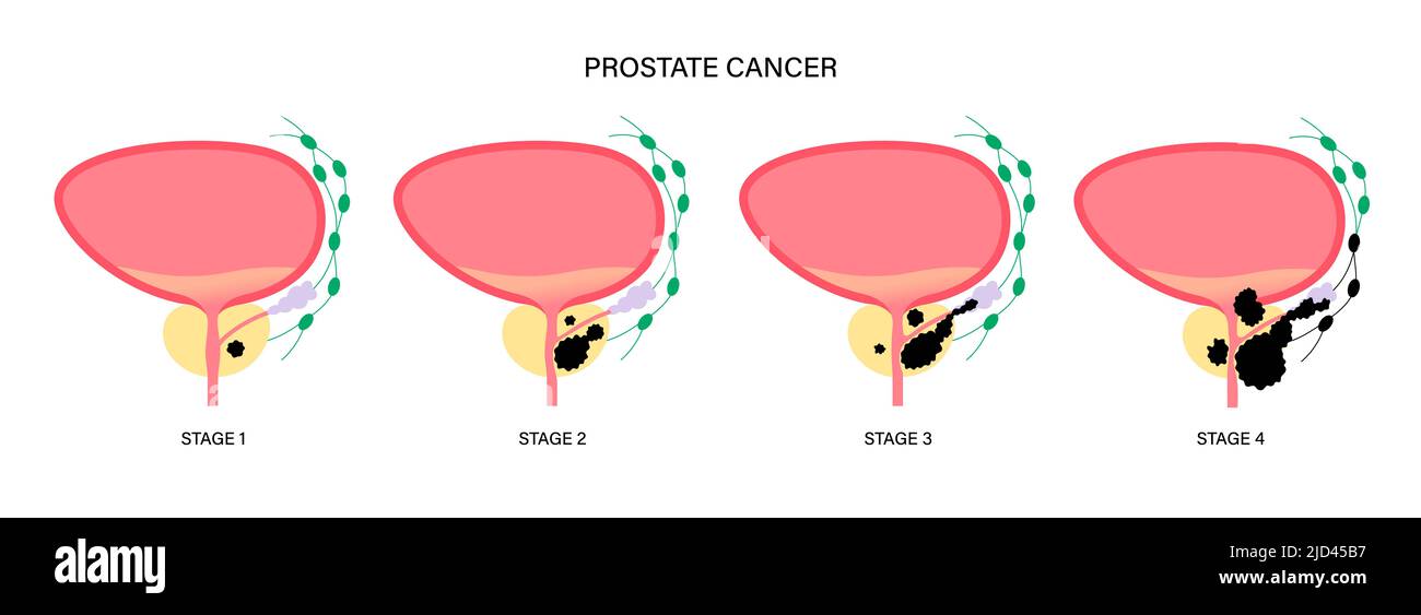Prostate cancer, illustration Stock Photo - Alamy