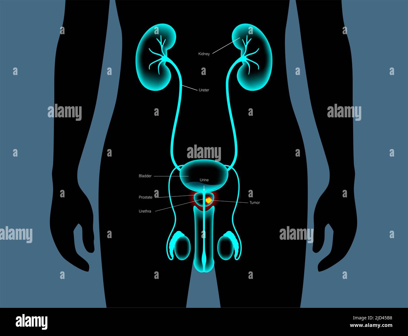 Prostate cancer, illustration Stock Photo - Alamy