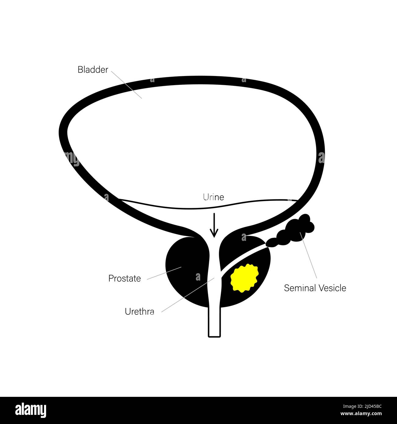 Prostate cancer, illustration Stock Photo - Alamy