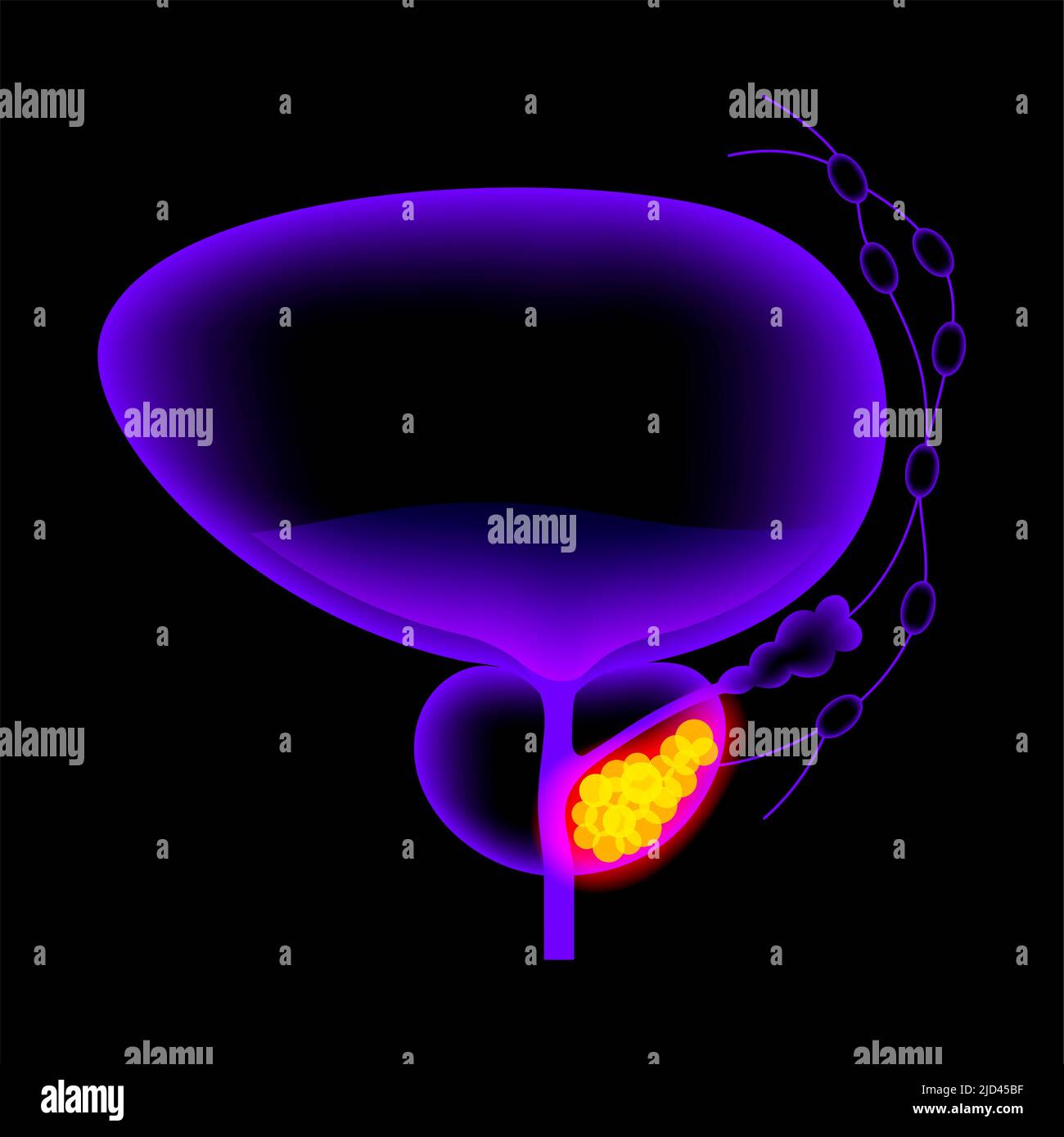 Prostate cancer, illustration Stock Photo - Alamy