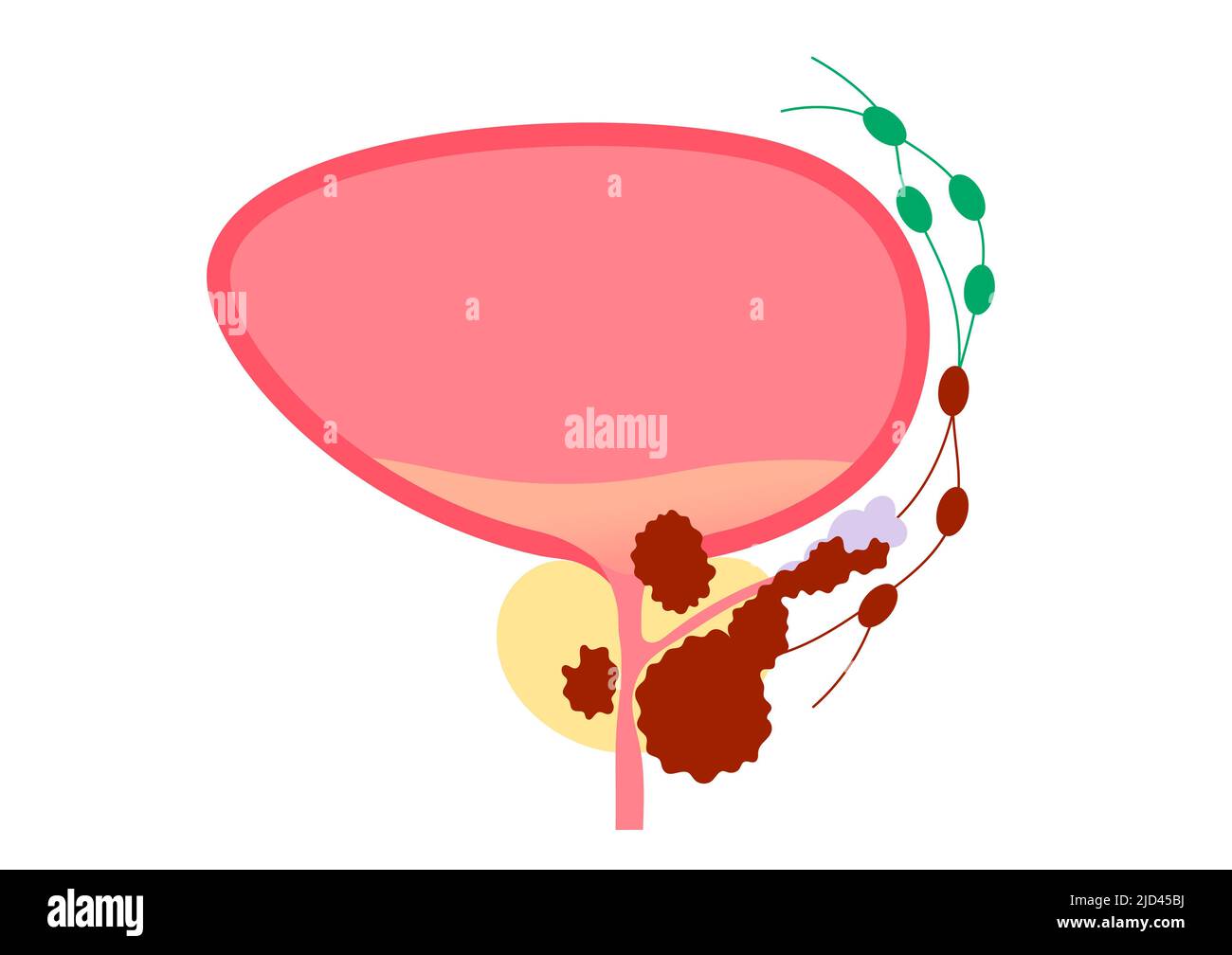 Prostate cancer, illustration Stock Photo - Alamy