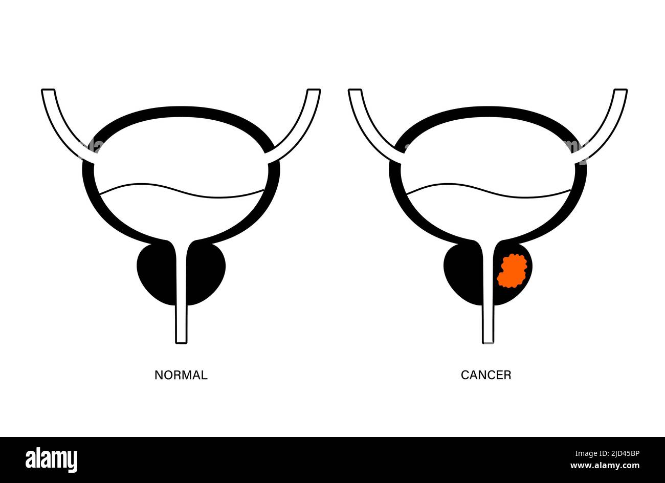 Prostate cancer, illustration Stock Photo - Alamy