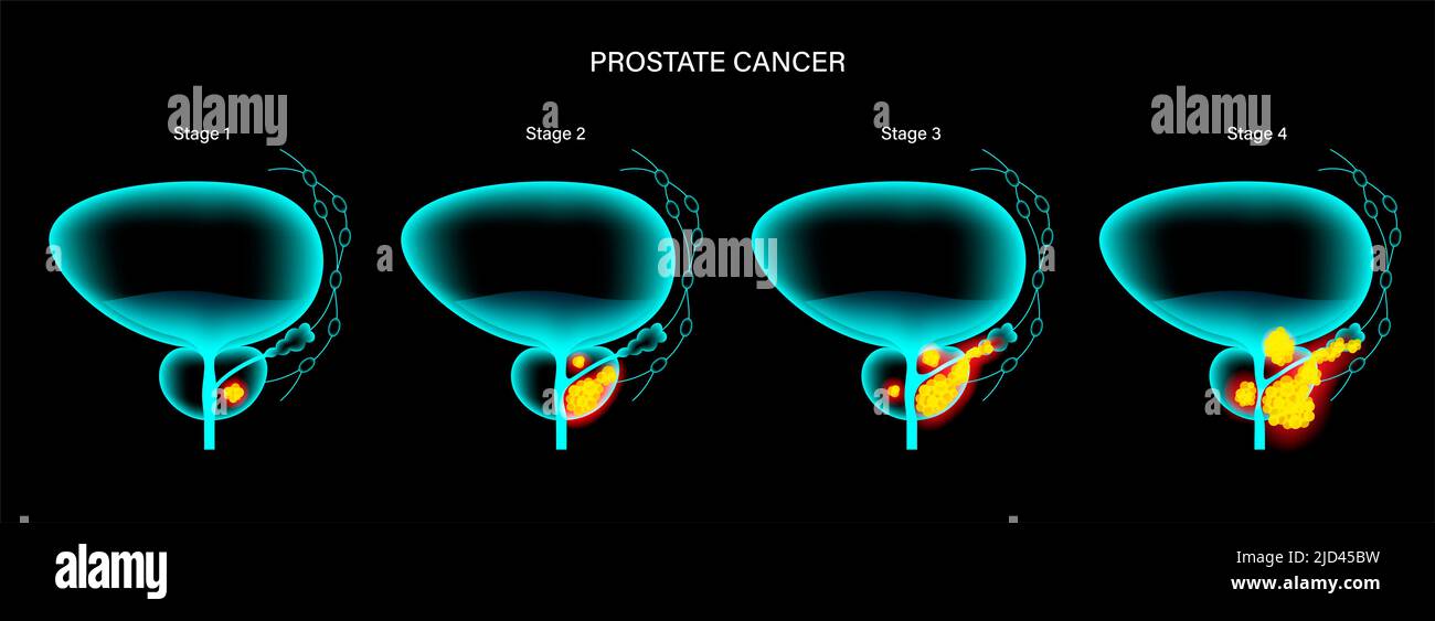 Prostate cancer, illustration Stock Photo - Alamy