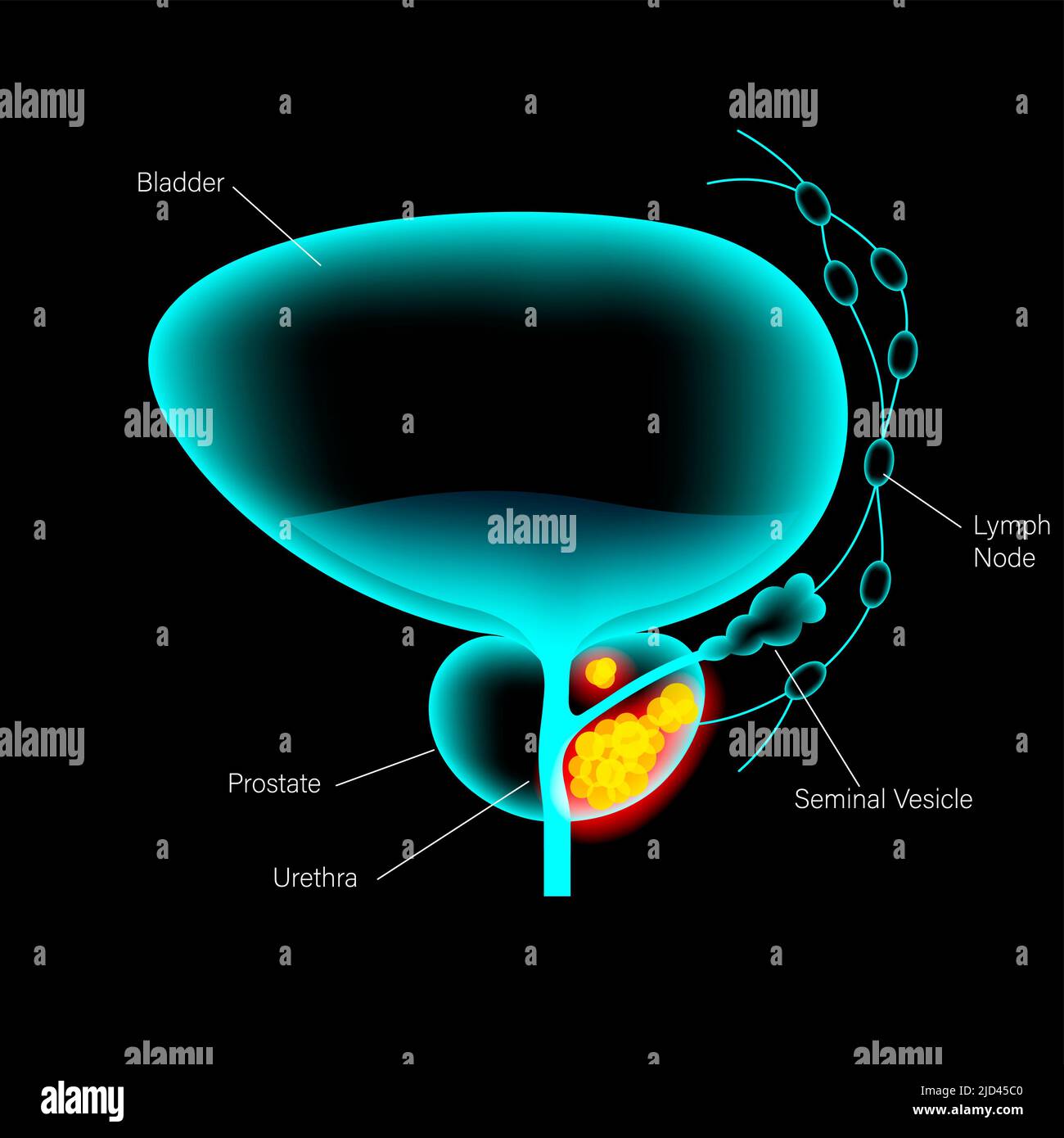 Prostate cancer, illustration Stock Photo - Alamy