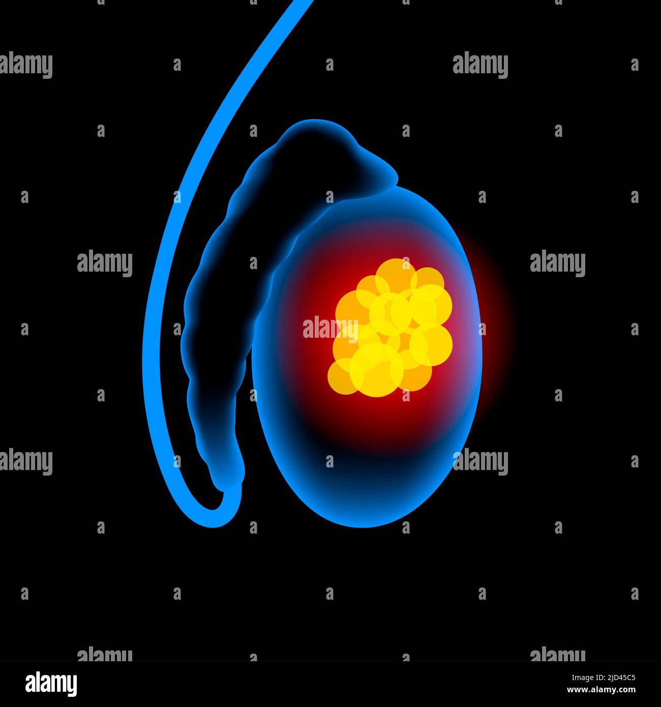 Prostate cancer, illustration Stock Photo - Alamy