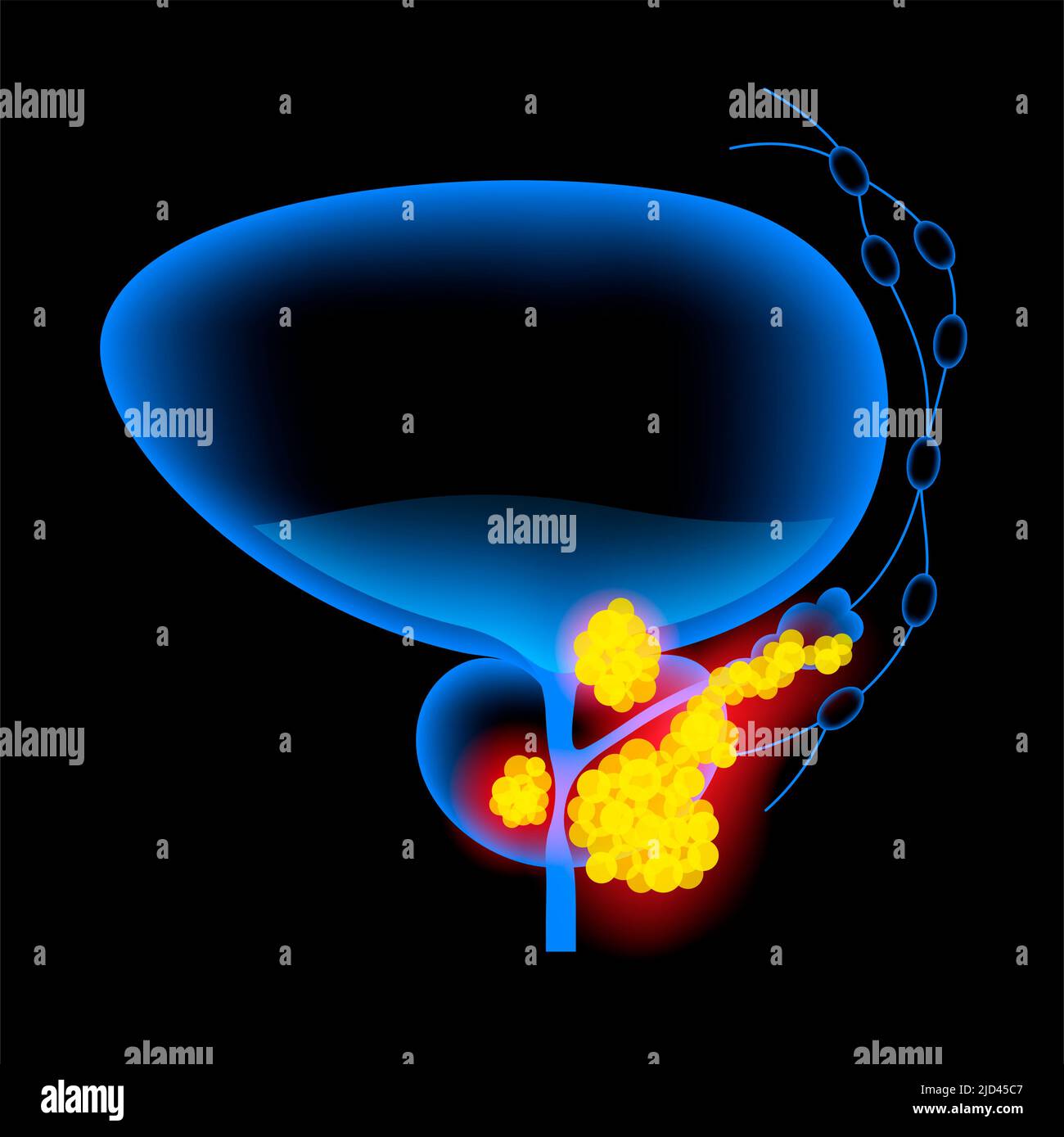 Prostate cancer, illustration Stock Photo - Alamy