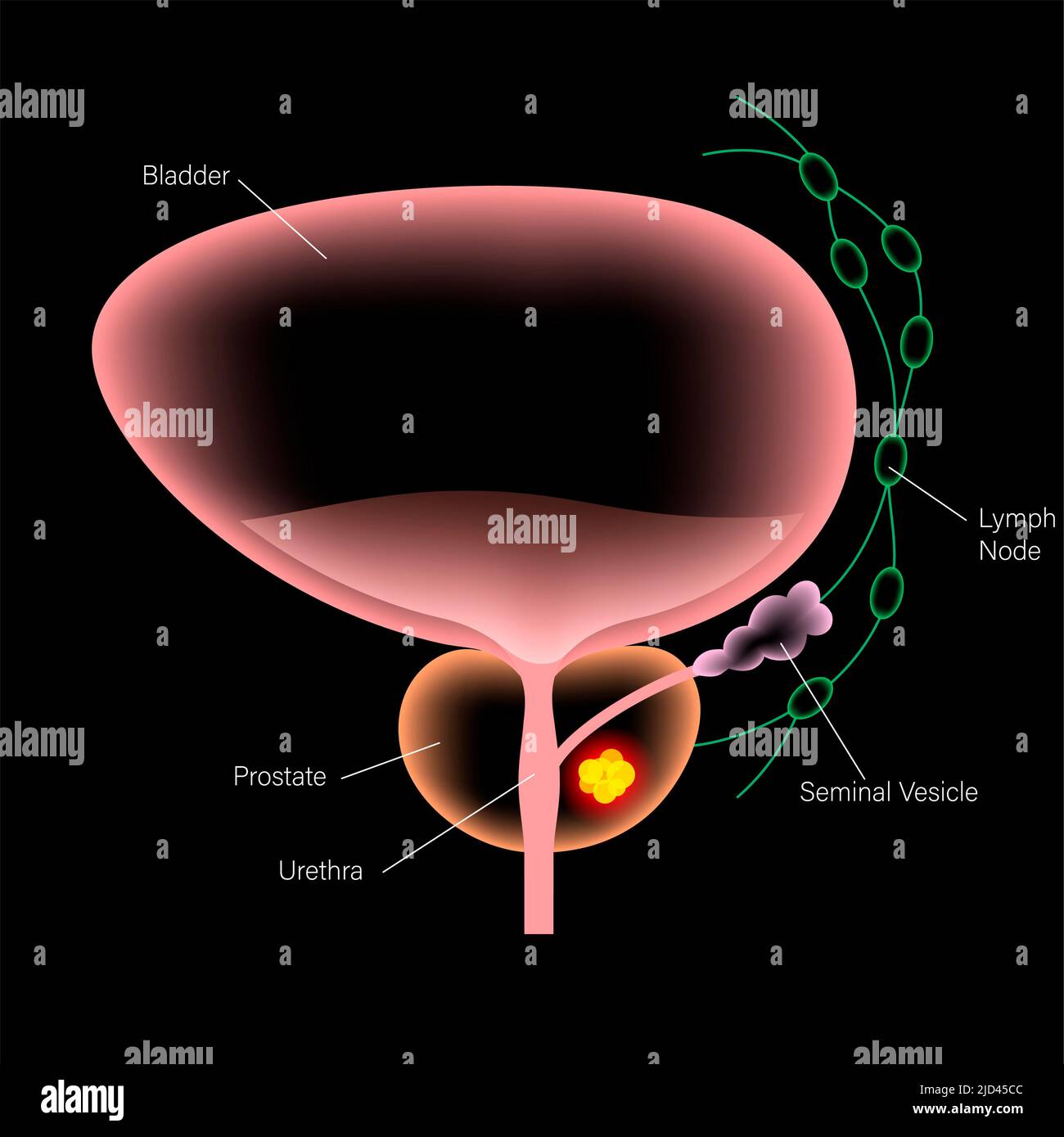 Prostate cancer, illustration Stock Photo - Alamy