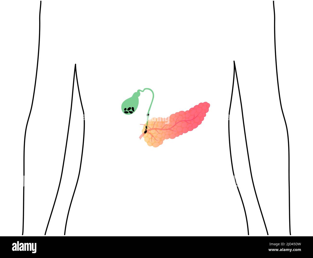 Gallstone pancreatitis hi-res stock photography and images - Alamy