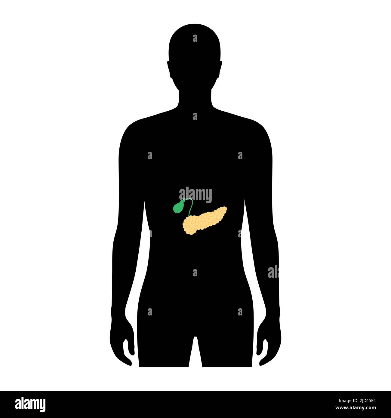 Gallstone pancreatitis hi-res stock photography and images - Alamy