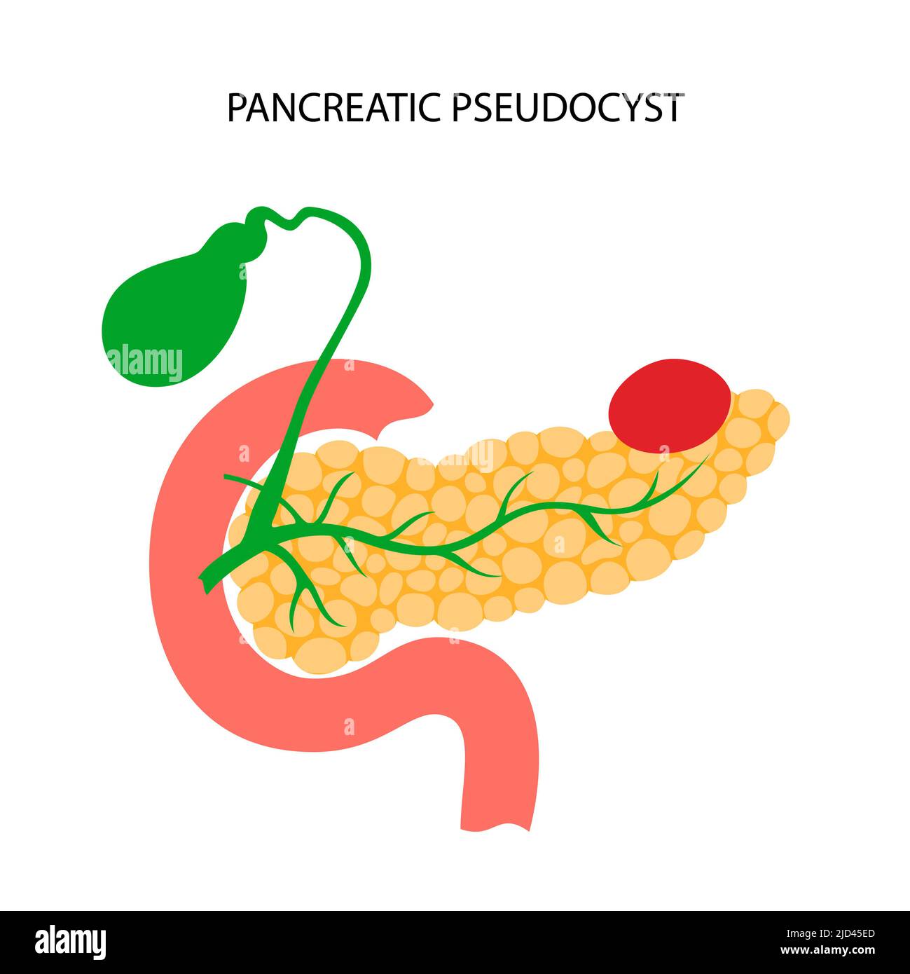 Pancreatic pseudocyst, illustration Stock Photo - Alamy