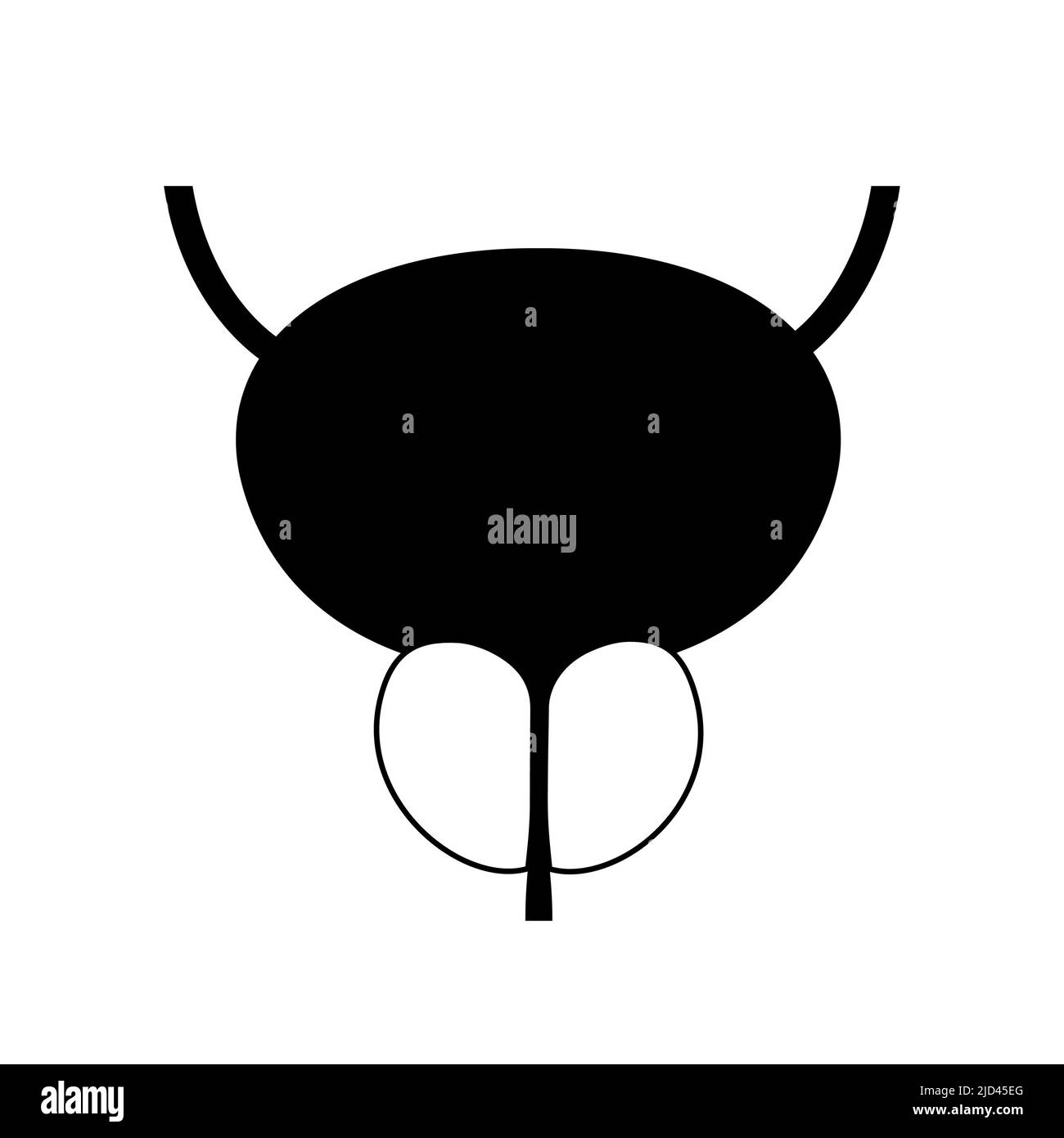 Benign prostatic hyperplasia, illustration Stock Photo - Alamy