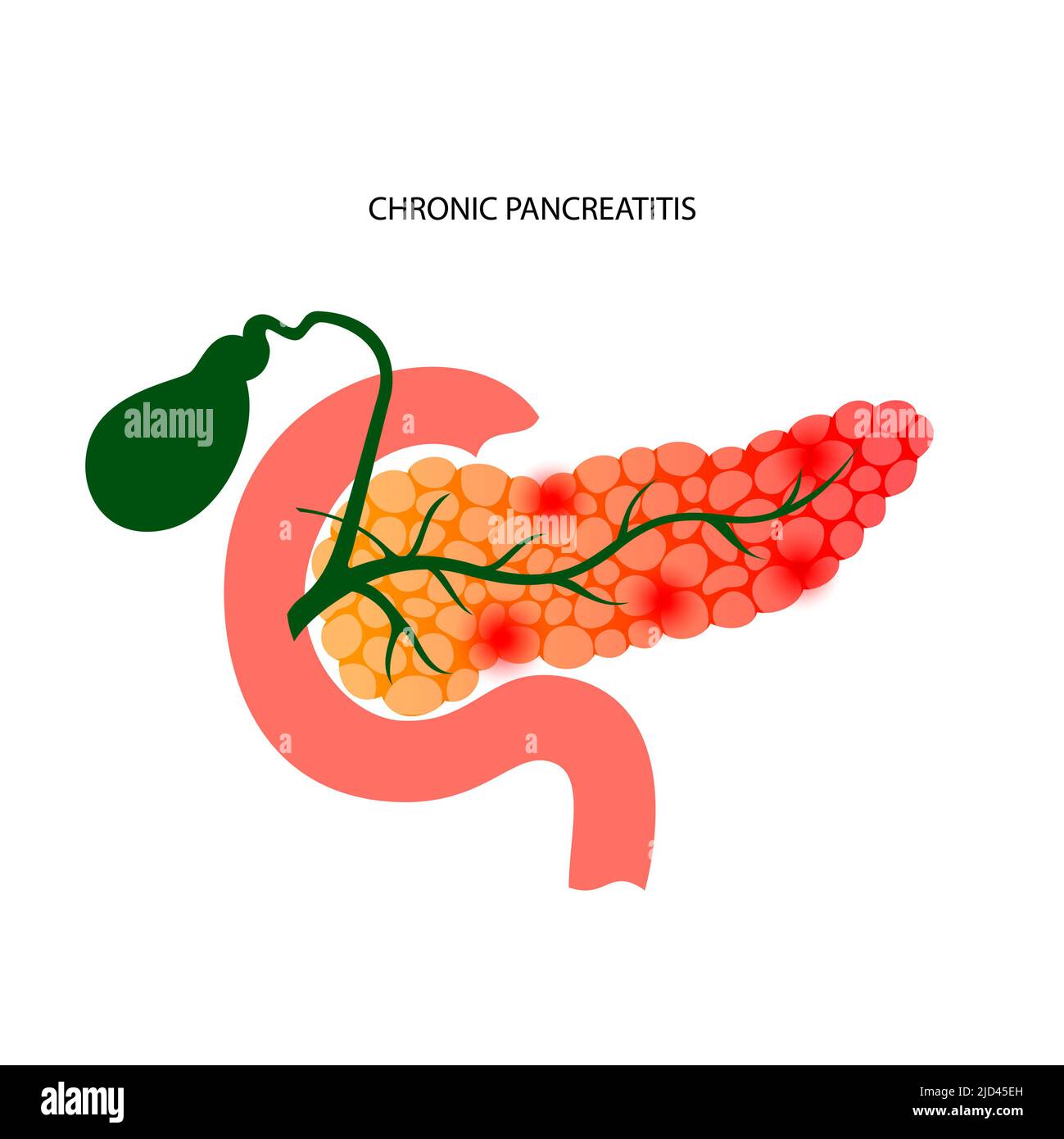 Chronic pancreatitis, illustration Stock Photo - Alamy