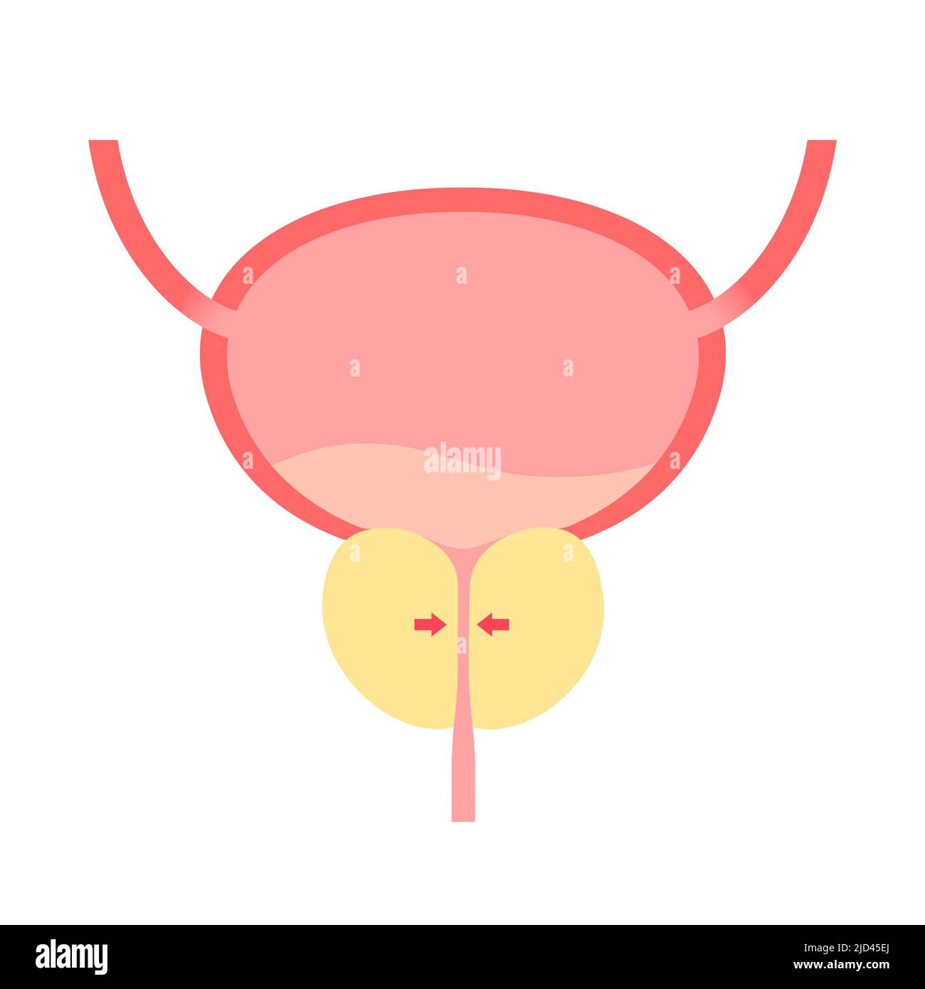 Benign prostatic hyperplasia, illustration Stock Photo - Alamy