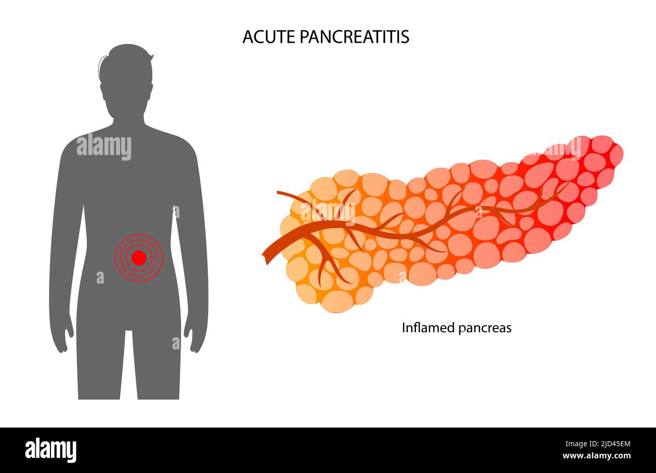 Acute pancreatitis, illustration Stock Photo - Alamy