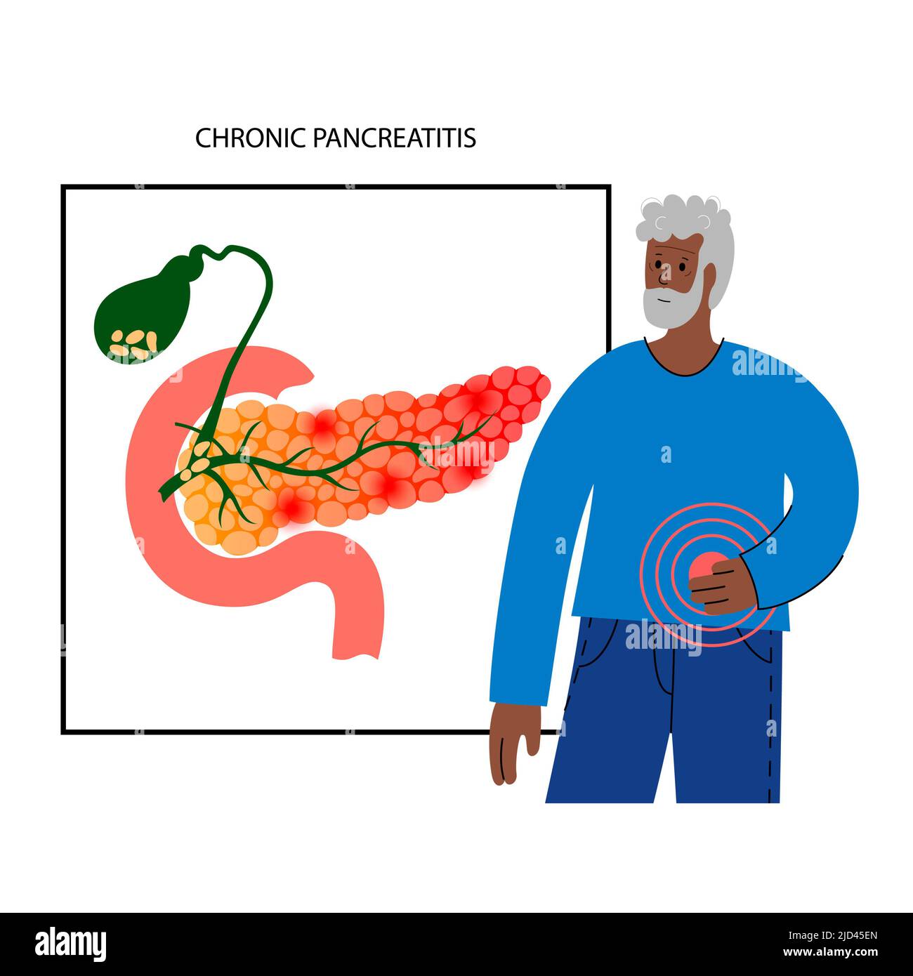 Chronic pancreatitis, illustration Stock Photo - Alamy