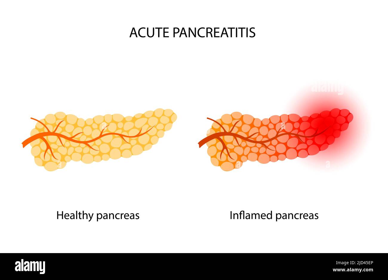 Acute pancreatitis, illustration Stock Photo - Alamy