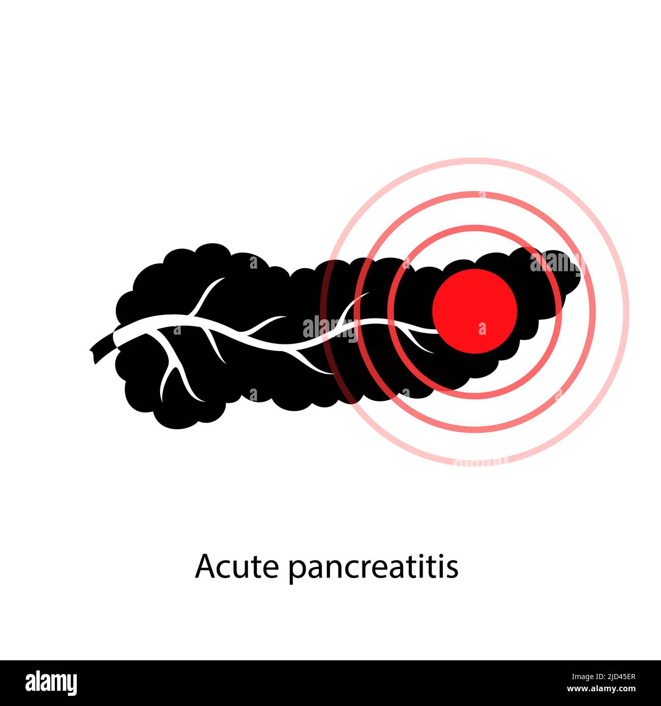 Acute pancreatitis, illustration Stock Photo - Alamy
