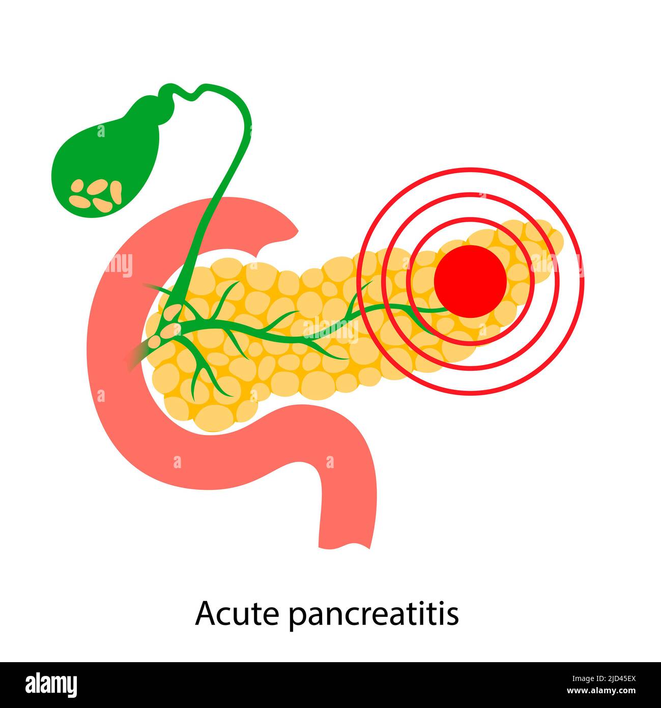 Acute pancreatitis, illustration Stock Photo - Alamy