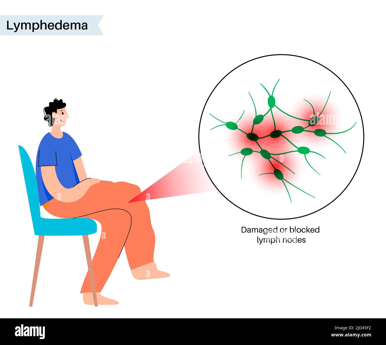 Lymphoedema leg swelling, illustration Stock Photo - Alamy