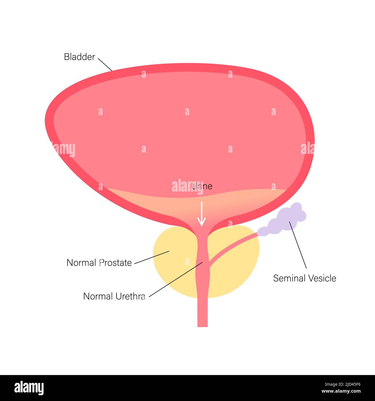 Benign prostatic hyperplasia, illustration Stock Photo - Alamy