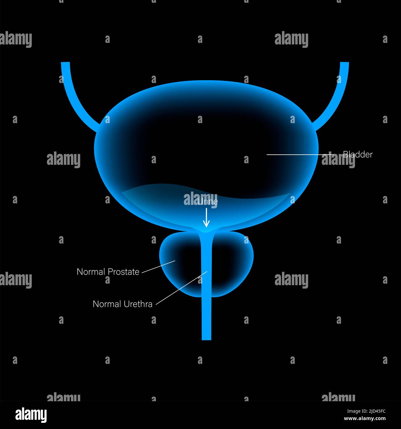 Benign prostatic hyperplasia, illustration Stock Photo - Alamy