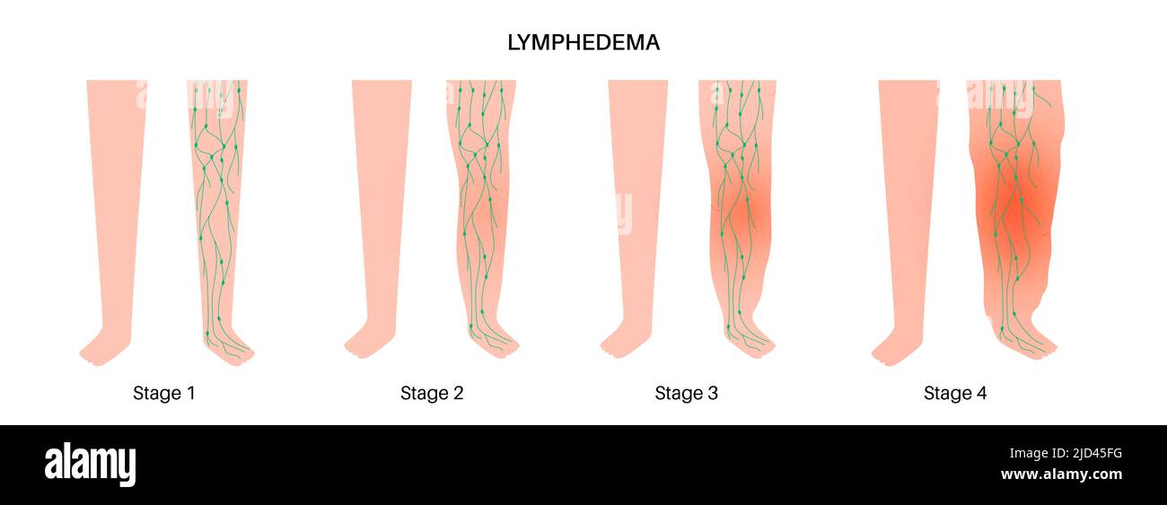 Stages of lymphoedema, illustration Stock Photo - Alamy