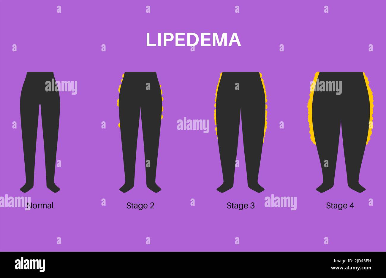 Lipoedema fat zones, illustration Stock Photo - Alamy