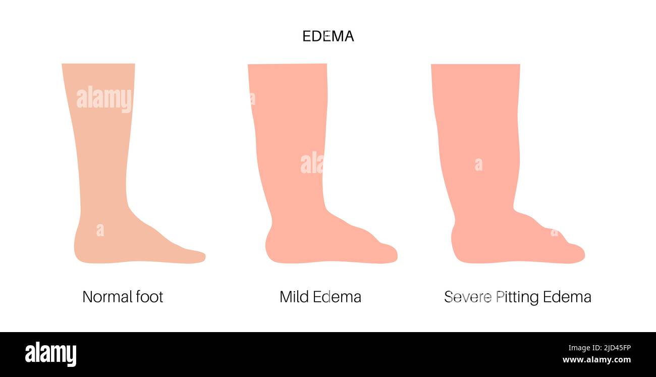 Oedema of feet , illustration Stock Photo - Alamy