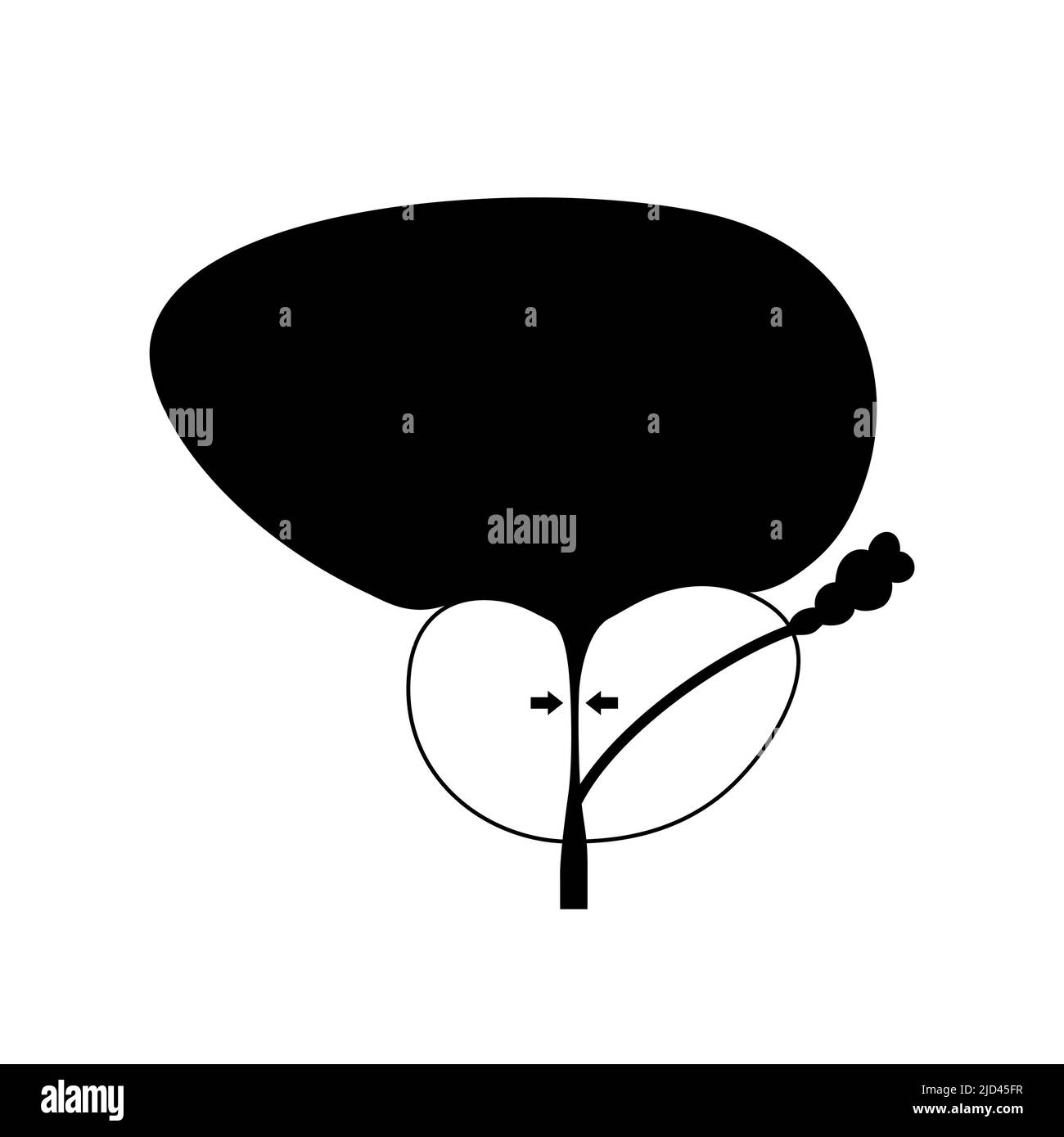 Benign prostatic hyperplasia, illustration Stock Photo - Alamy