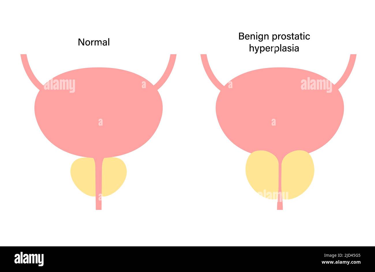 Benign prostatic hyperplasia, illustration Stock Photo - Alamy