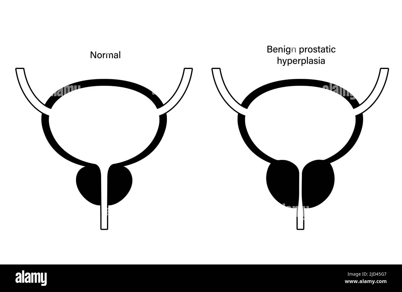 Benign prostatic hyperplasia, illustration Stock Photo - Alamy