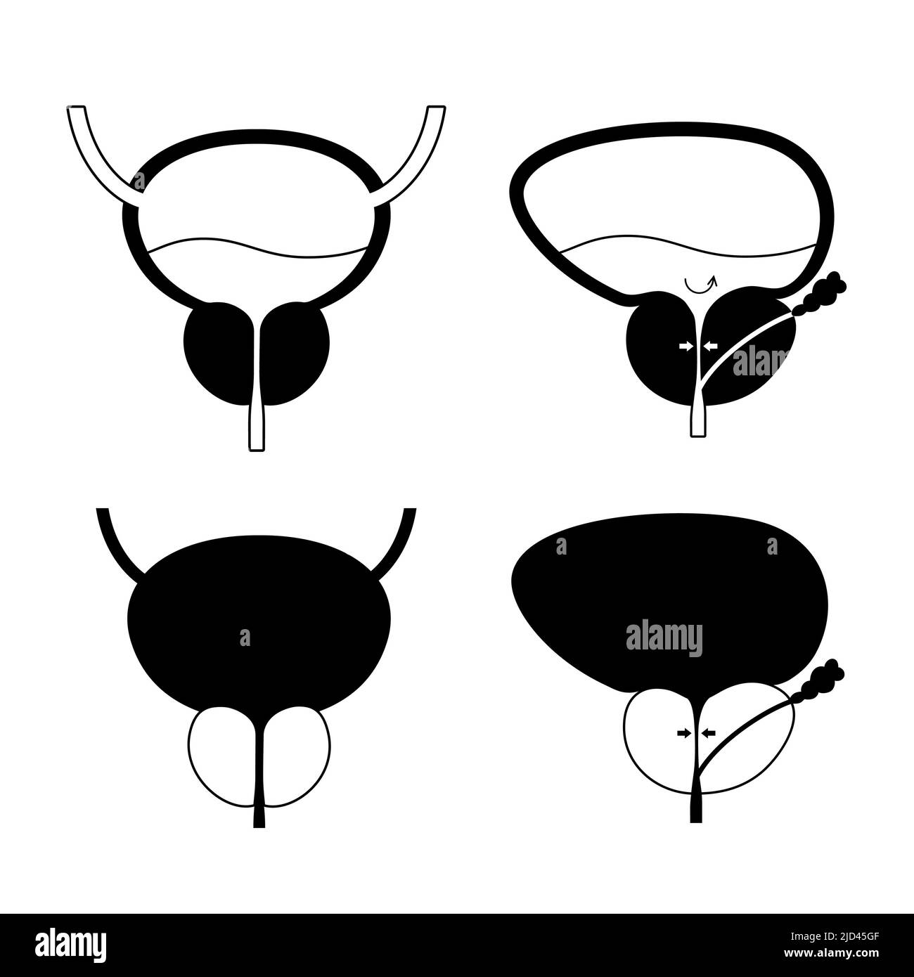 Benign prostatic hyperplasia, illustration Stock Photo - Alamy