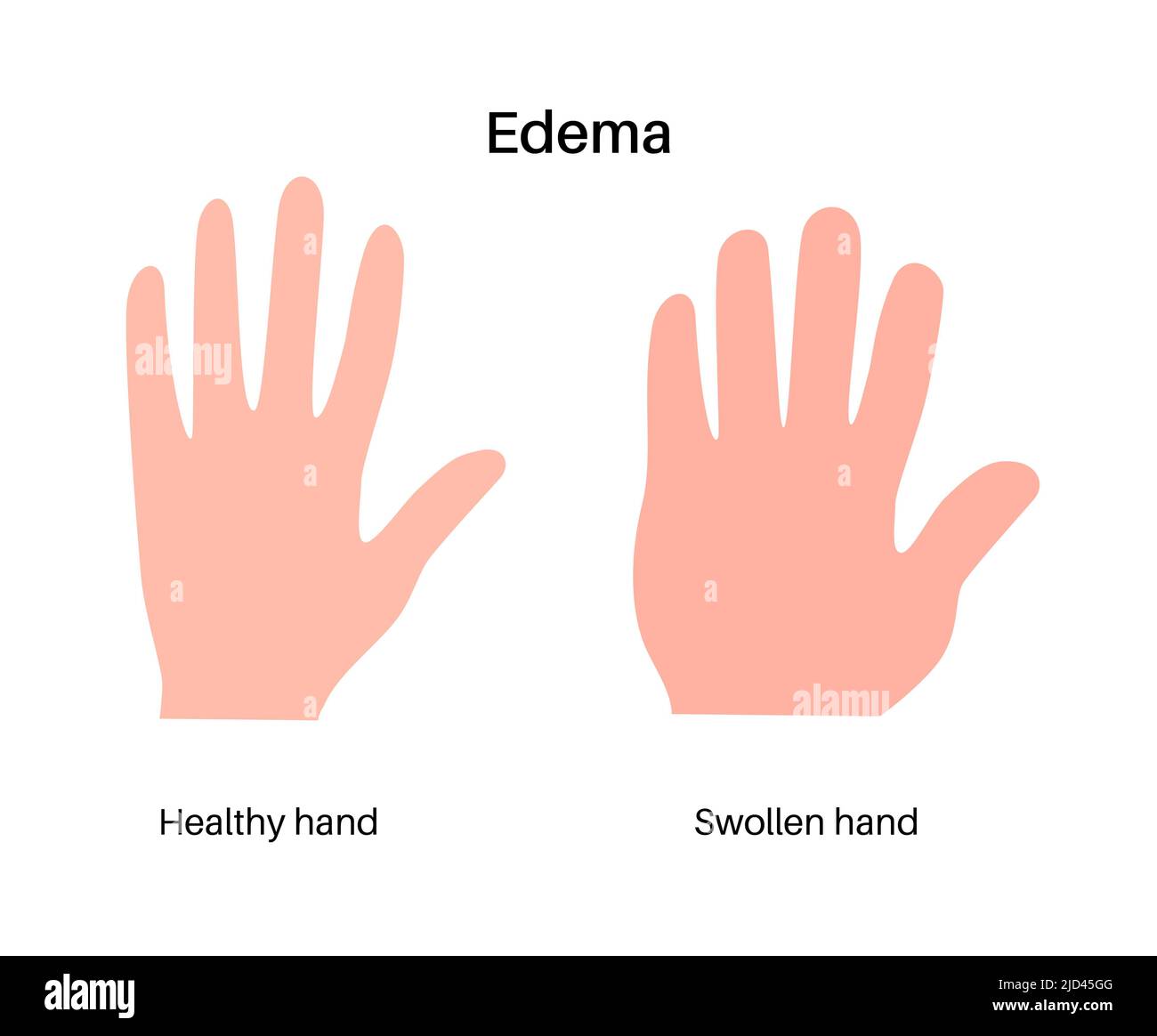 Oedema of arm, illustration Stock Photo - Alamy