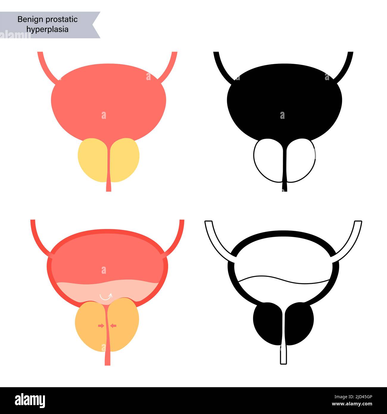 Benign prostatic hyperplasia, illustration Stock Photo - Alamy