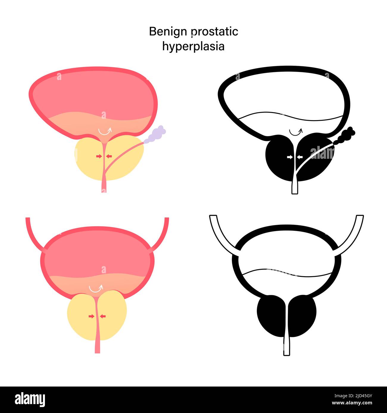 Benign prostatic hyperplasia, illustration Stock Photo - Alamy